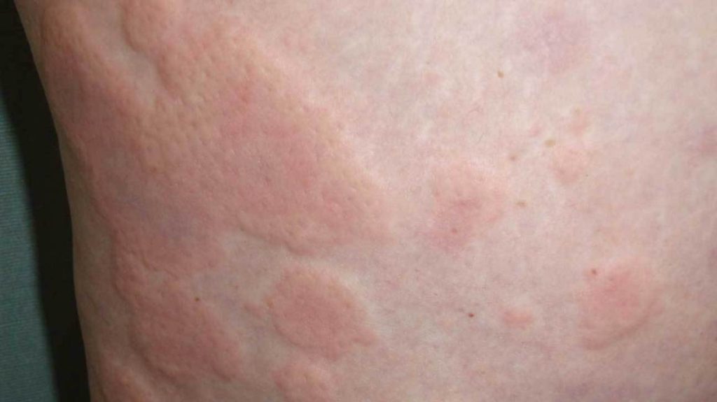 Understanding Hives: Causes, Symptoms, and Treatment – APOMUDEN