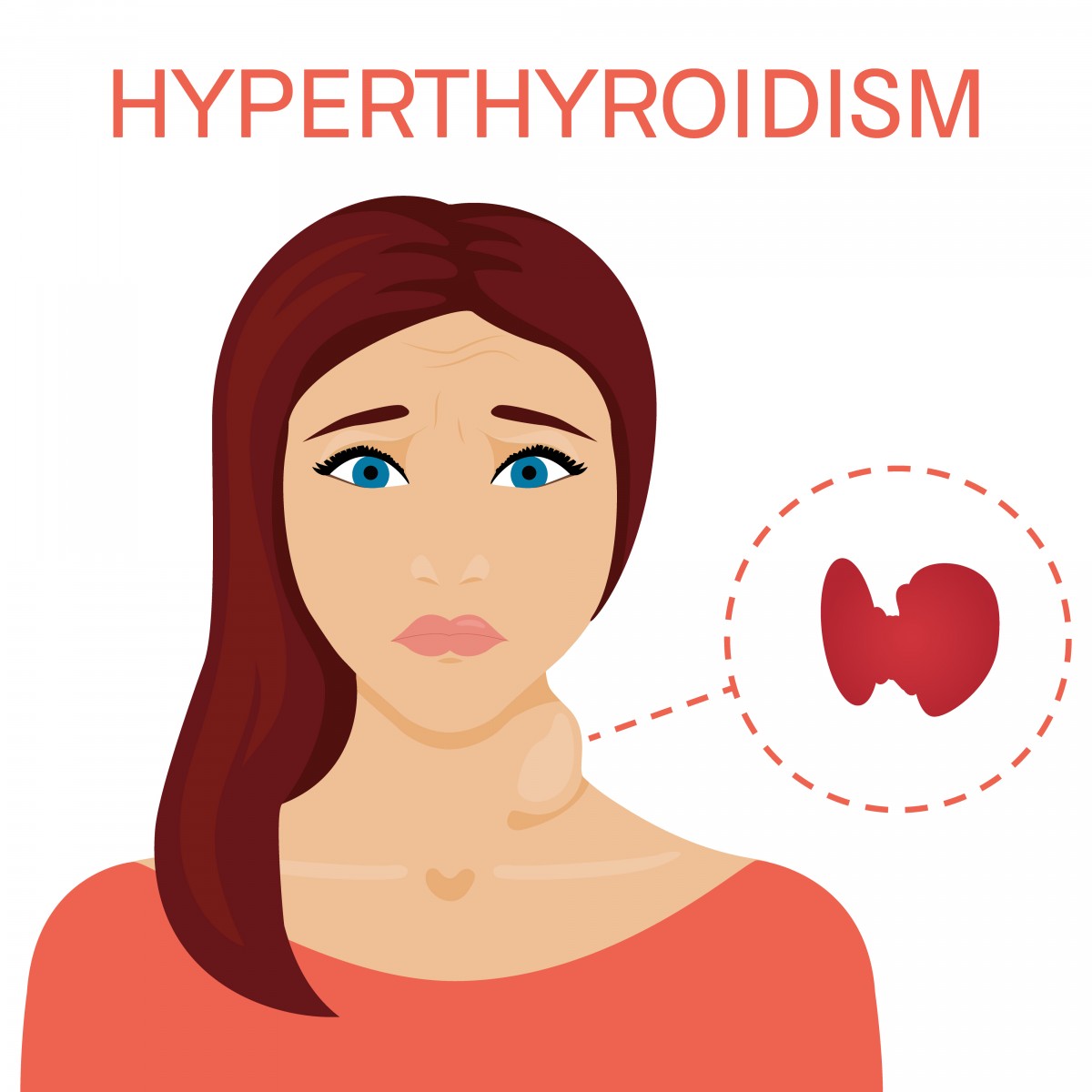 Hyperthyroidism Causes and Effective Treatments – APOMUDEN