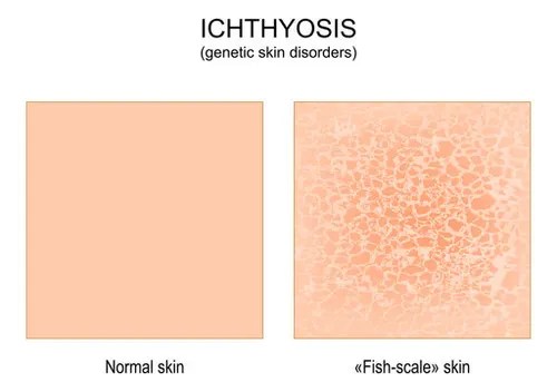 Understanding Ichthyosis: Symptoms and Treatments – APOMUDEN